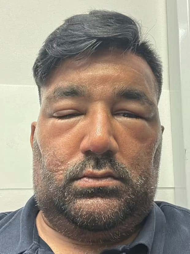 People with Severely Swollen Faces from Allergies | KLYKER.COM