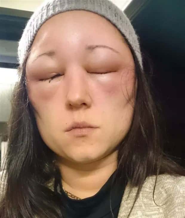 People with Severely Swollen Faces from Allergies | KLYKER.COM