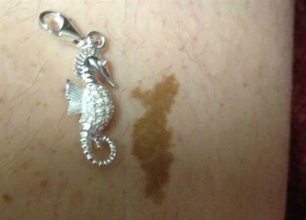 28 People Flaunting Their Cool Birthmarks | KLYKER.COM